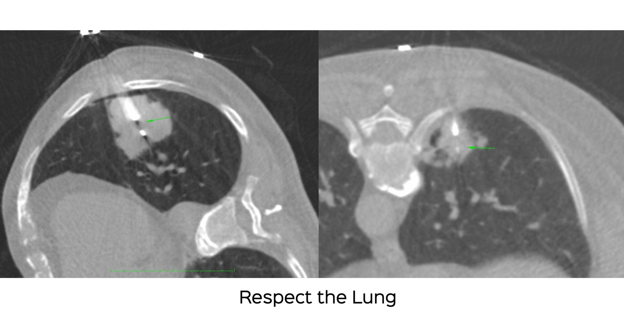Respect the Lung - A Tale of Two Biopsies and Complications