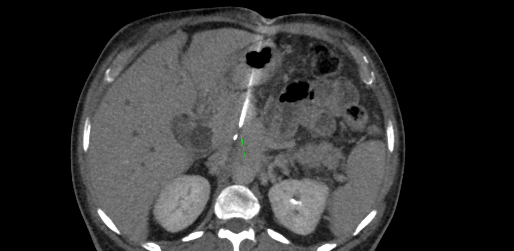Pancreas - CT Guided Biopsy