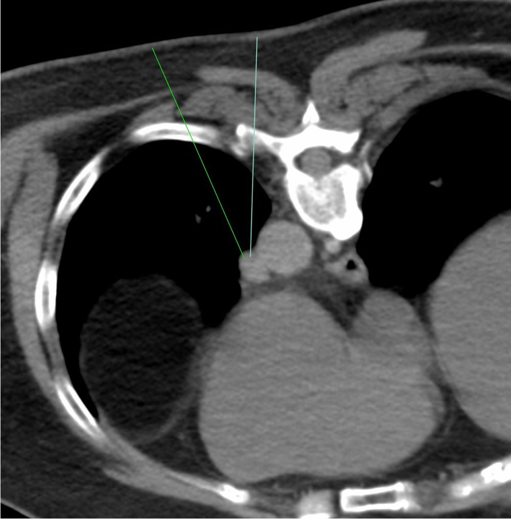 Case 124: Left Para-Aortic Posterior Mediastinal Node Biopsy