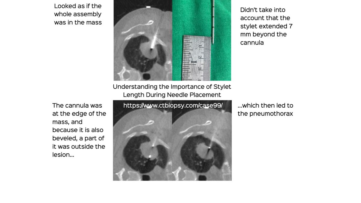 Case 99: Understanding the Importance of Stylet Length During Needle ...