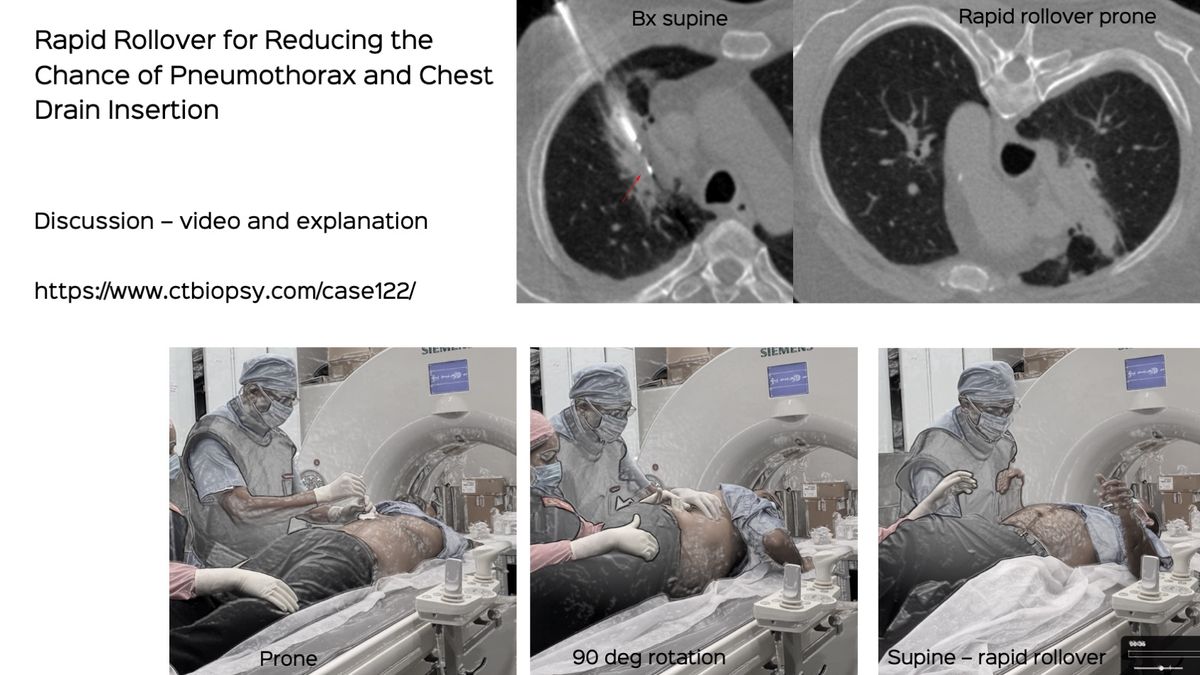 Case 122: Rapid Rollover to Reduce the Rate of Exit Pneumothorax and Chest Drain Insertion