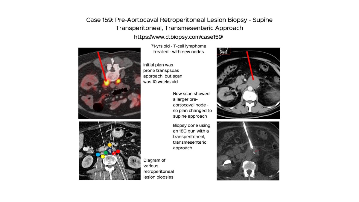 Case 159: Pre-Aortocaval Retroperitoneal Lesion Biopsy - Supine Transperitoneal, Transmesenteric ...