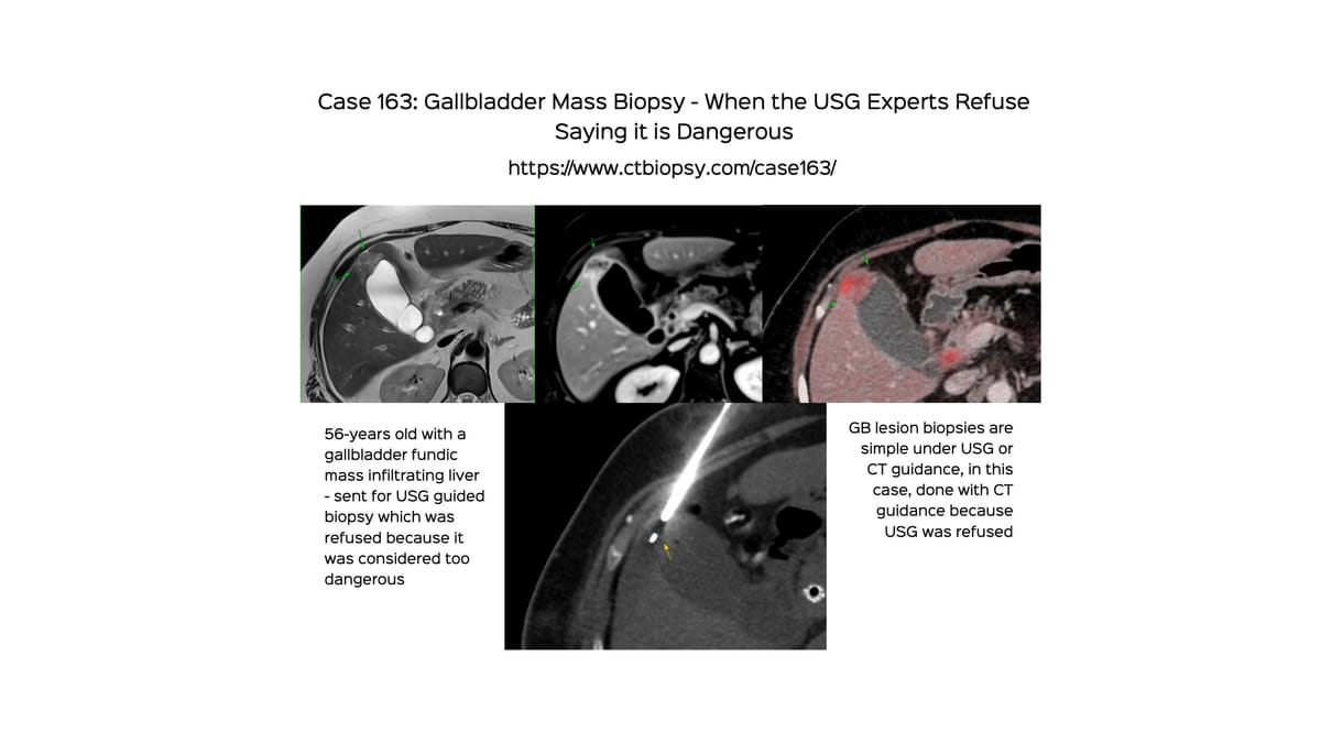 Case 163: Gallbladder Mass Biopsy - When USG Experts Say it is Risky to ...