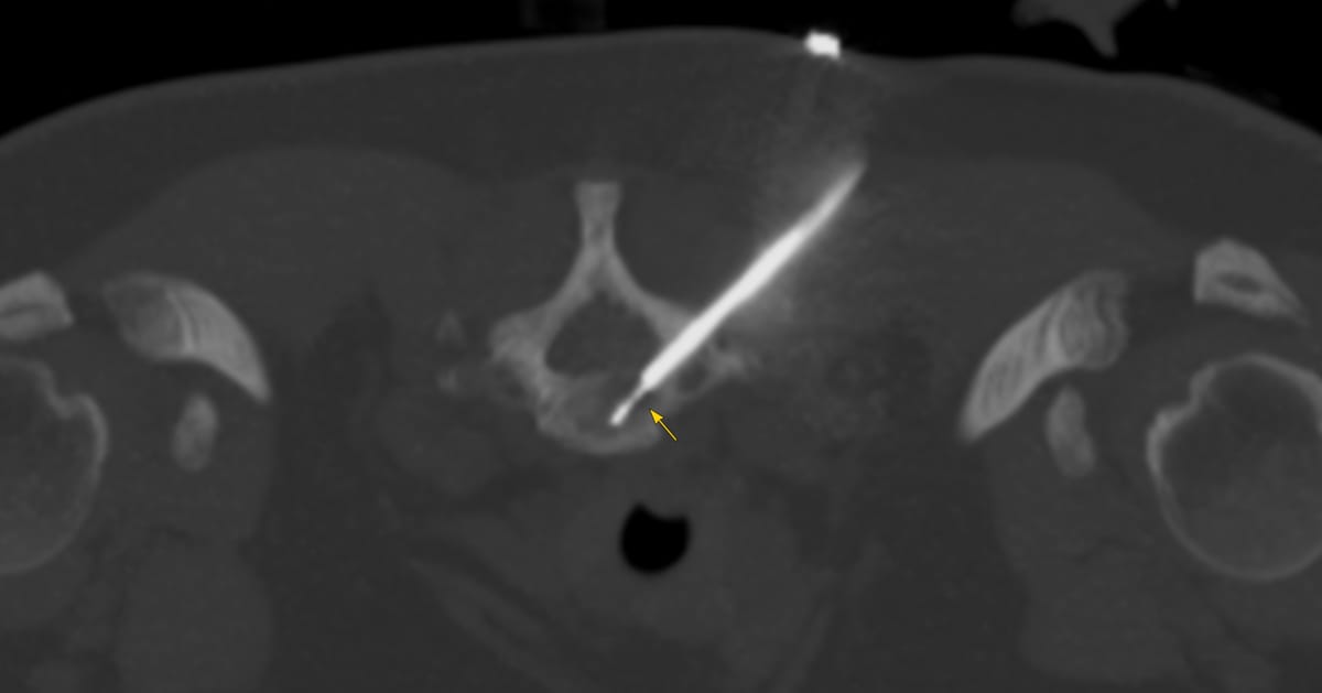 Case 167: Transpedicular Approach for a Lower Cervical Body Lesion